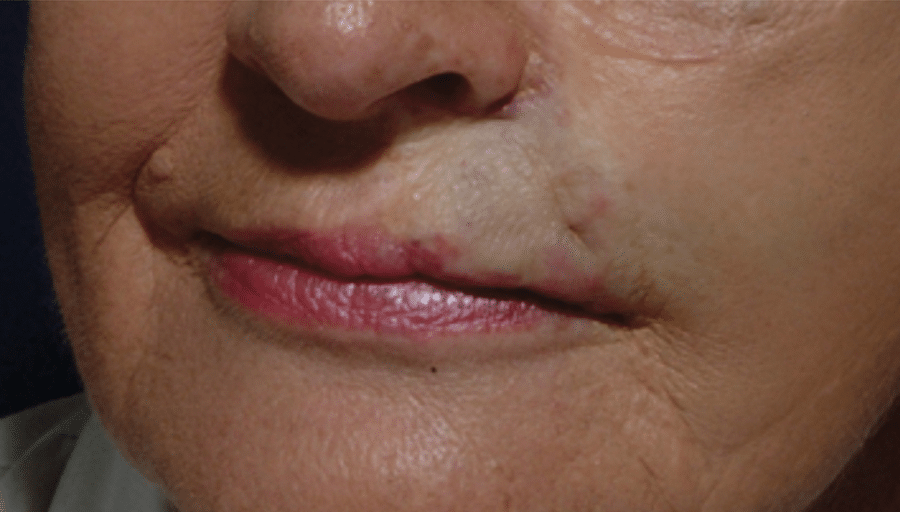 Port Wine Stains - Austin Laser Solutions