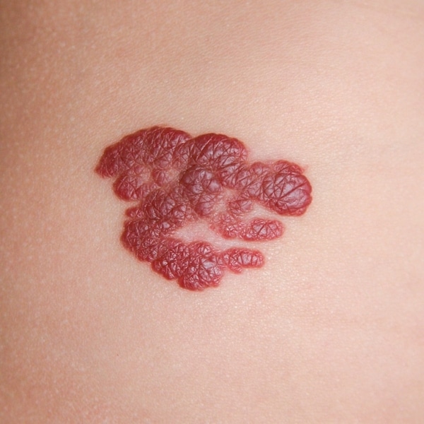 Port Wine Stains - Austin Laser Solutions